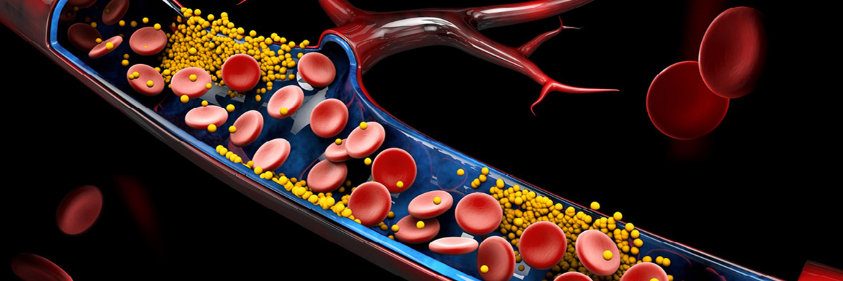 Familial Hypercholesterolemia: Causes, Symptoms, and Natural Ways to ...